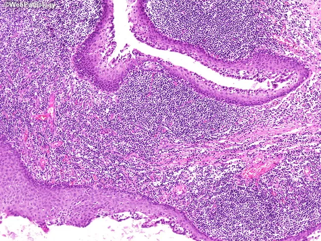 Lymphoepithelial Cyst