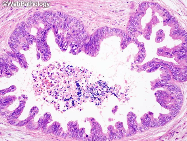 IPMN : Pancreatobiliary