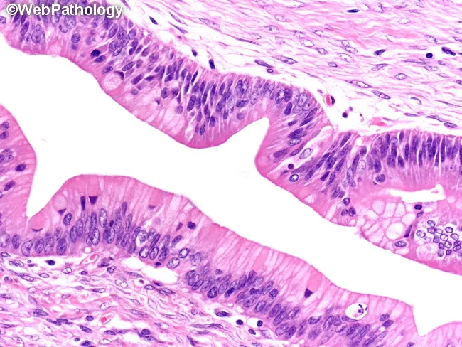 Mucinous Cystic Neoplasm : Low-grade