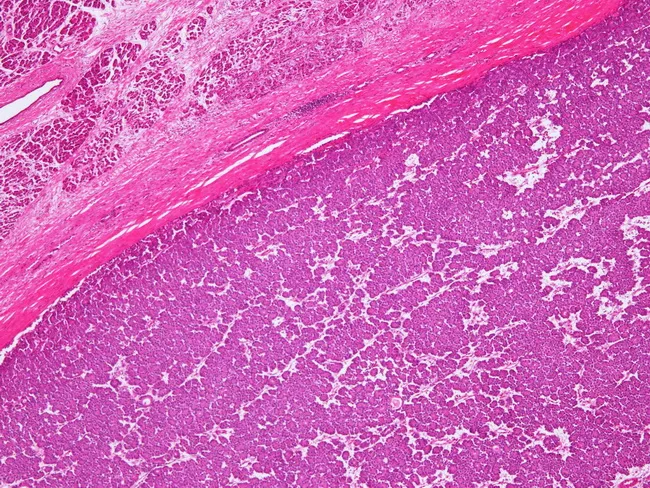 Acinar Cell CA : Clinica Features