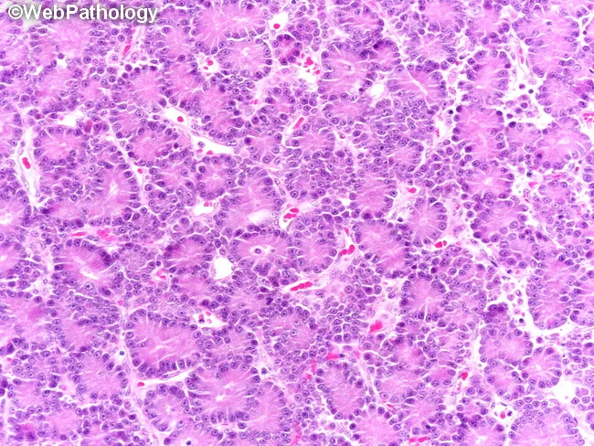 Acinar Cell CA : Microscopic