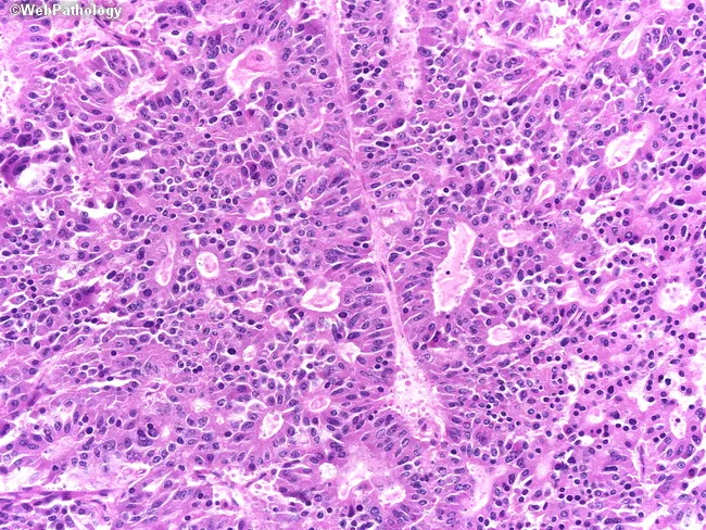 Acinar Cell CA : Microscopic