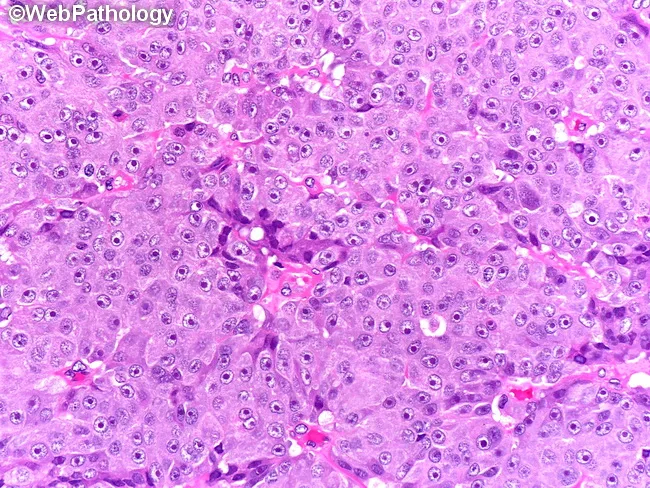 Acinar Cell CA : Microscopic