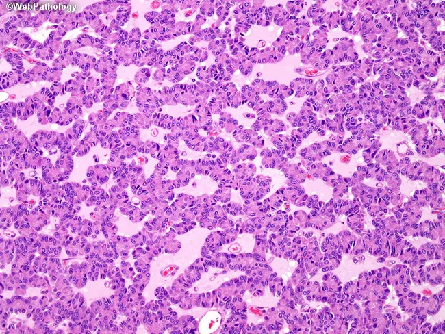 Acinar Cell CA : Microscopic
