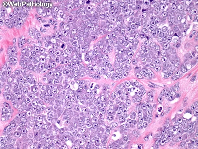 Acinar Cell CA : Molecular Genetics