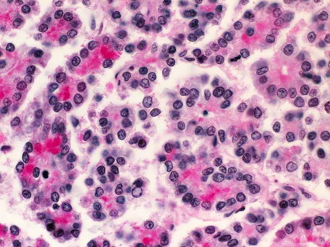 Acinar Cell CA : PAS-D