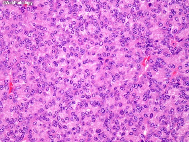 Acinar Cell CA
