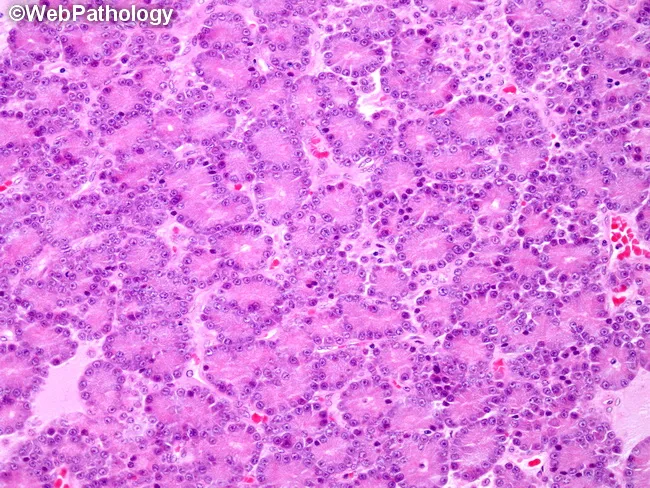 Acinar Cell CA