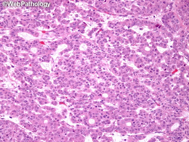Acinar Cell CA