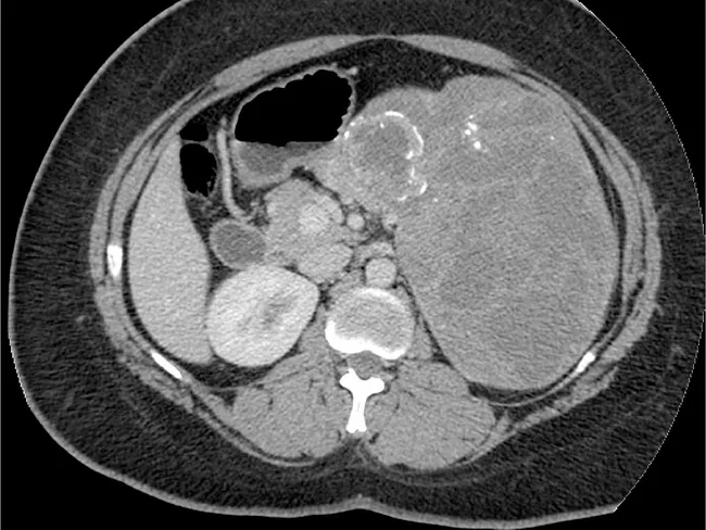 Solid Pseudopapillary Tumor : Radiology
