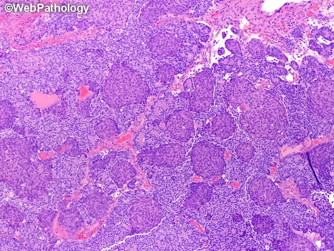 Pancreatoblastoma : Clinical Features