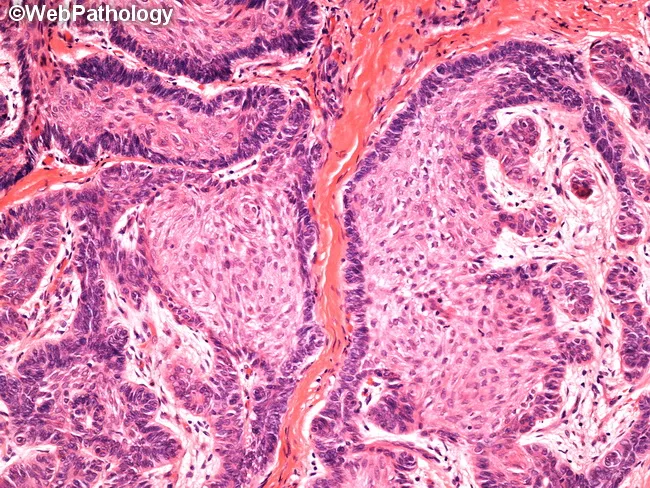 follicular atrophoderma