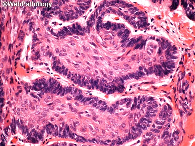 Ameloblastoma : Follicular Pattern