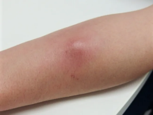 Nodular Fasciitis : Intro & Clinical