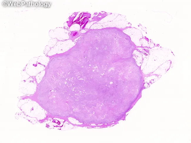 Nodular Fasciitis