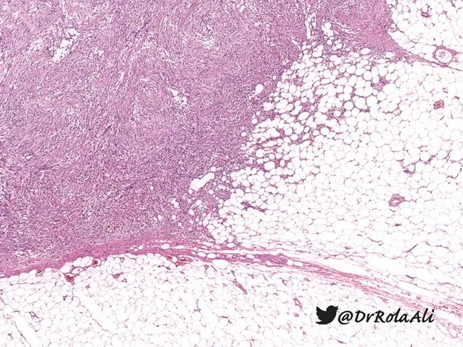 Nodular Fasciitis