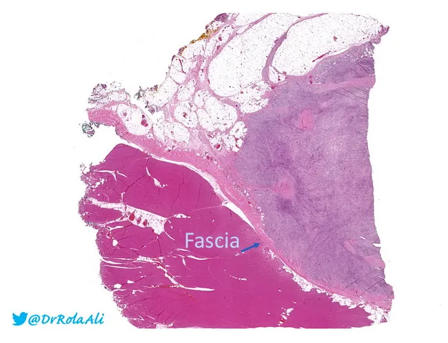 Nodular fasciitis : Microscopic