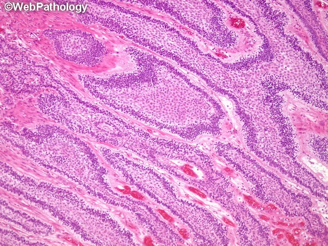 Ameloblastoma : Follicular Pattern