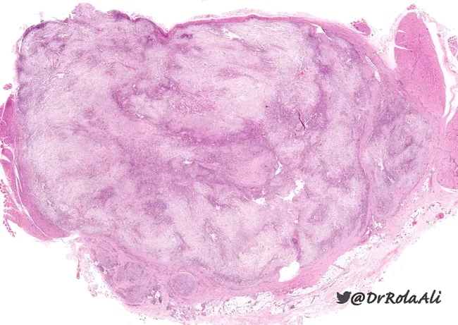 Nodular Fasciitis : Microscopic