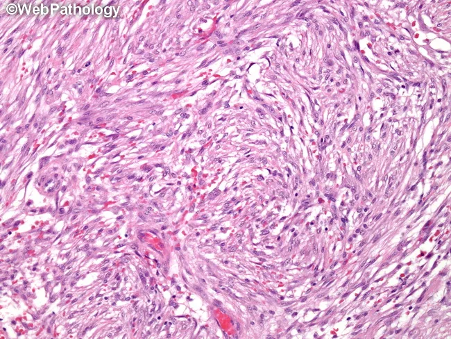 Nodular Fasciitis : Related Lesions