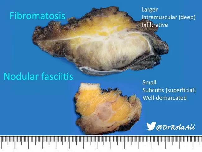 Nodular Fasciitis : Differential Diagnosis