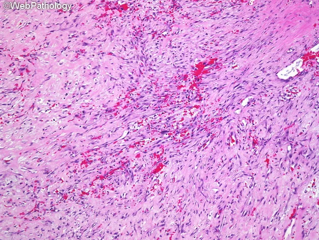Nodular Fasciitis : Treatment