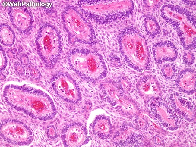 Ameloblastoma : Follicular Pattern