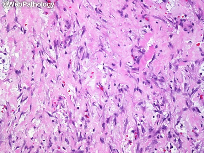 Nodular Fasciitis