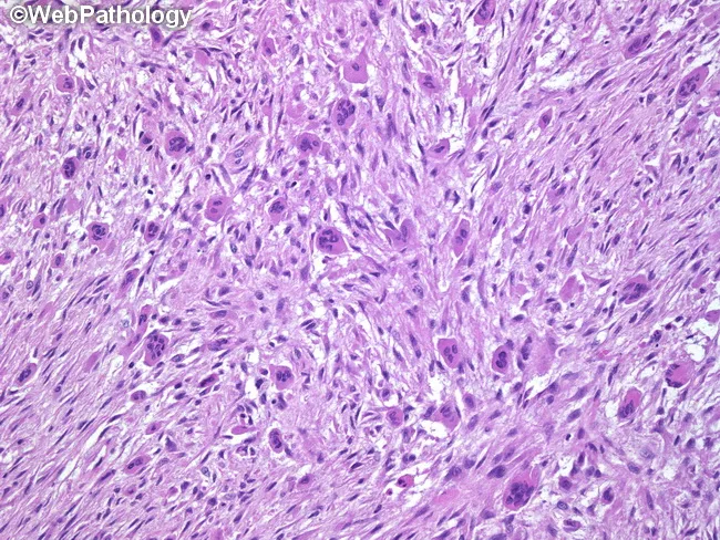 Nodular Fasciitis