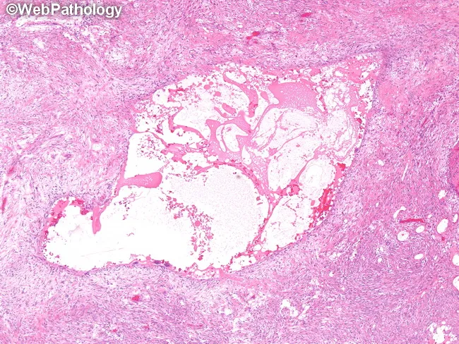 Nodular Fasciitis