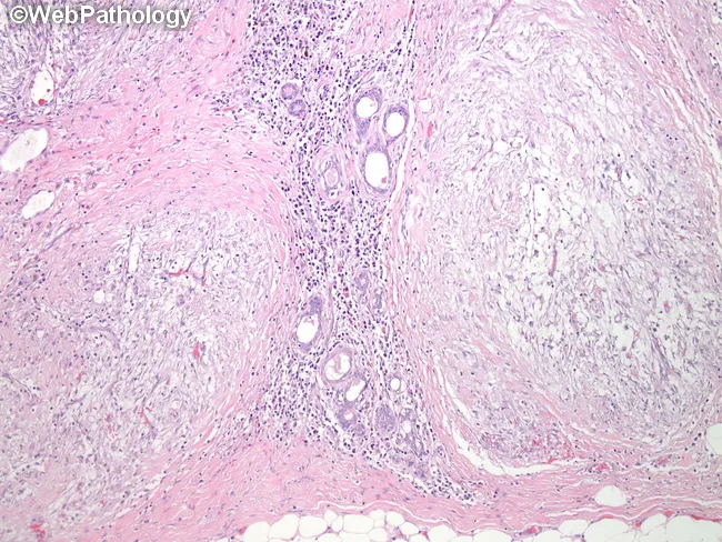 Nodular Fasciitis : Breast