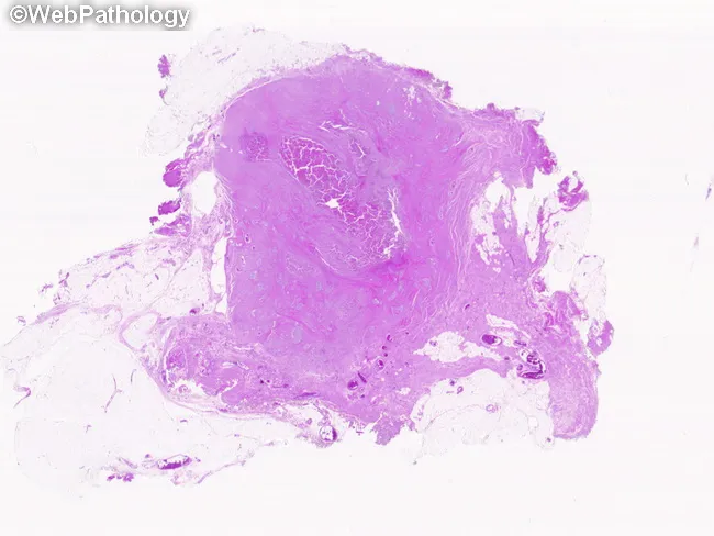 Proliferative Fasciitis : Intro & Clinical