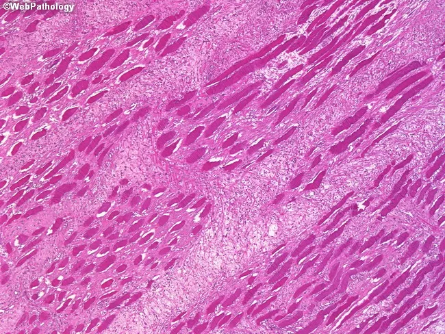Proliferative Myositis : Intro & Clinical