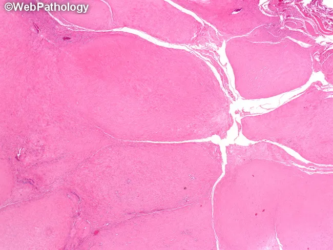 Fibroma of Tendon Sheath : Microscopic
