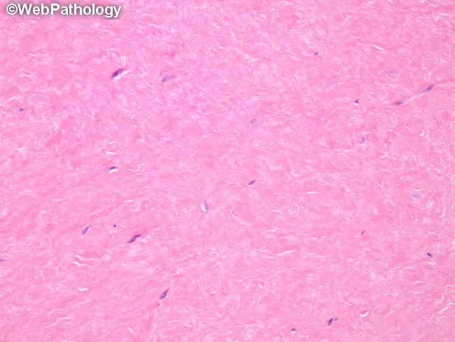 Fibroma of Tendon Sheath : Microscopic