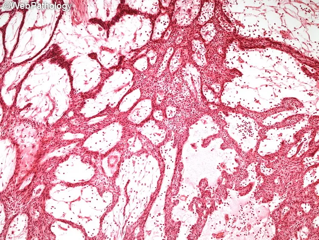 Ameloblastoma : Plexiform Pattern