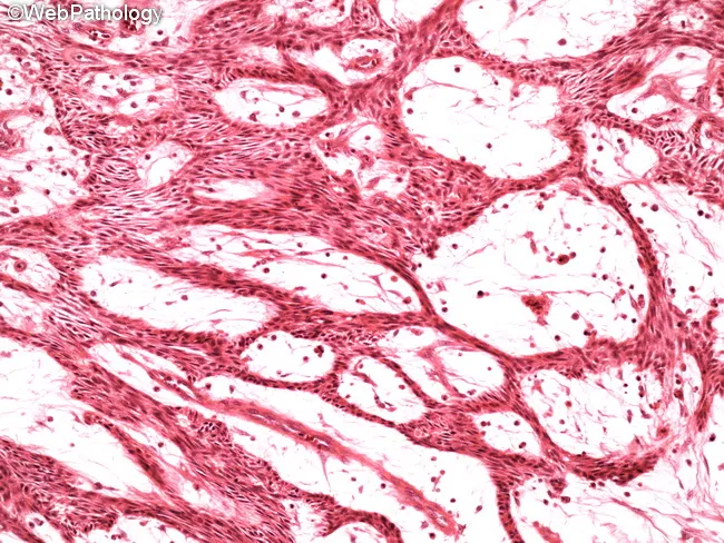 Ameloblastoma : Plexiform Pattern