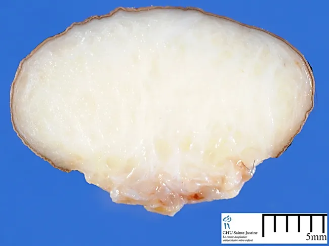 Keloid : Gross Pathology