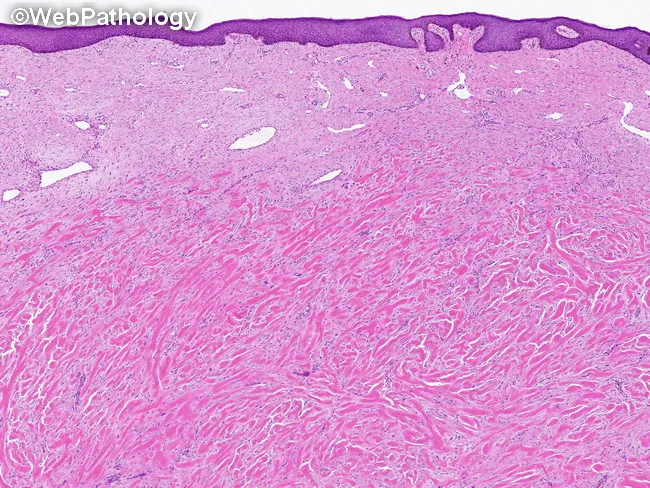 Keloid : Microscopic Features