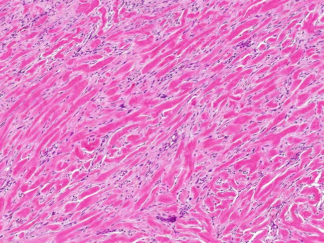 Keloid : Microscopic Features