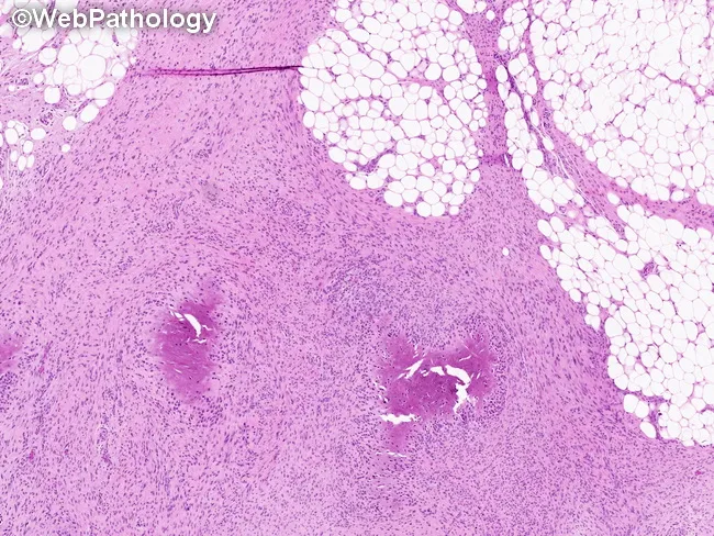 Calcifying Aponeurotic Fibroma : Microscopic