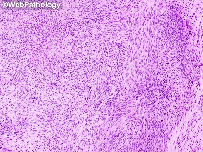 Calcifying Aponeurotic Fibroma : Microscopic
