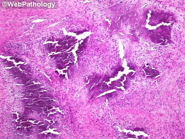 Calcifying Aponeurotic Fibroma : Microscopic