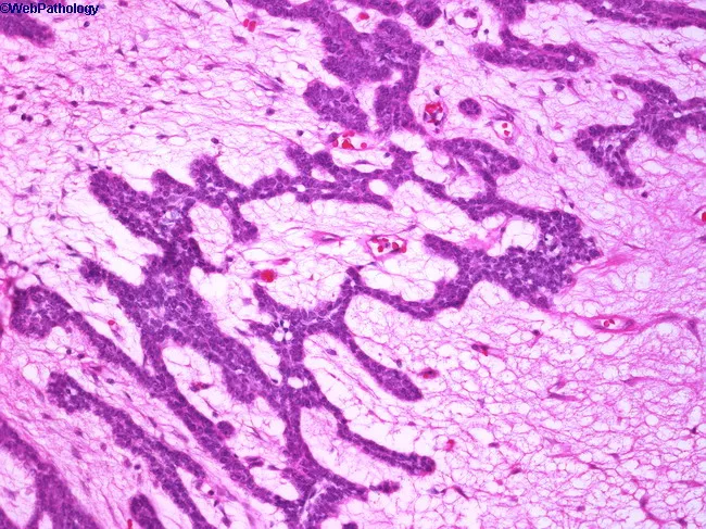 Ameloblastoma : Plexiform Pattern