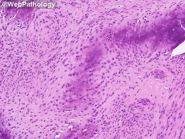 Calcifying Aponeurotic Fibroma : Differential Diagnosis