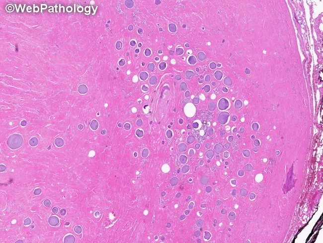 Calcifying Fibrous Tumor : Introduction & Clinical