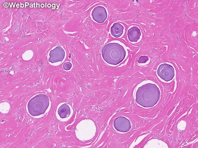 Calcifying Fibrous Tumor : Differential Diagnosis