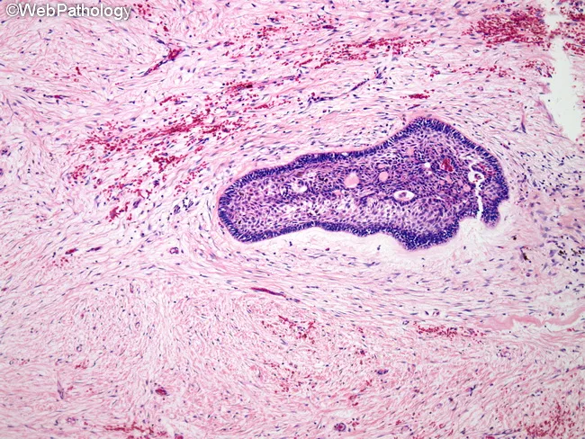 Ameloblastoma : Desmoplastic Pattern