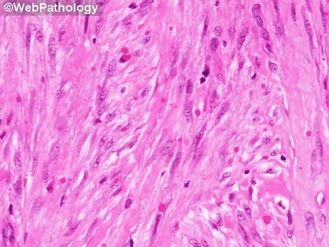 Inclusion Body Fibromatosis : Morphology