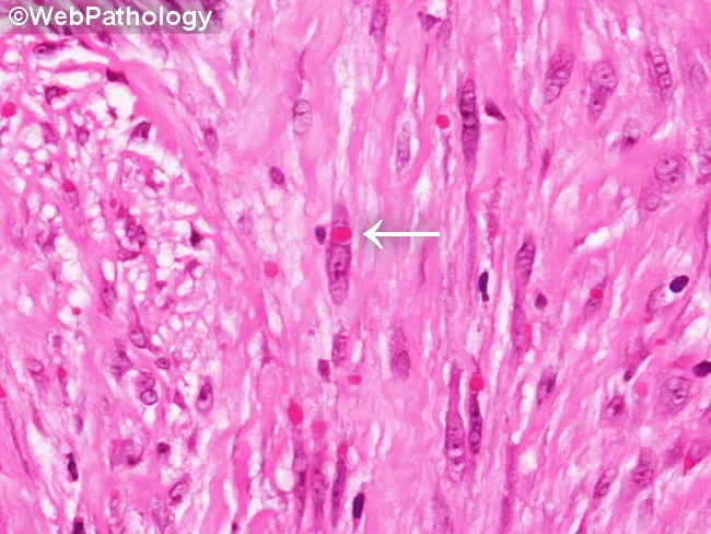 Inclusion Body Fibromatosis : Morphology